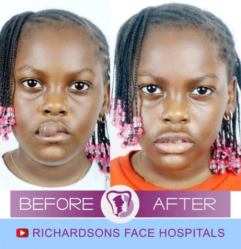 All That You Must Know About Capillary Hemangioma Treatment In India ...