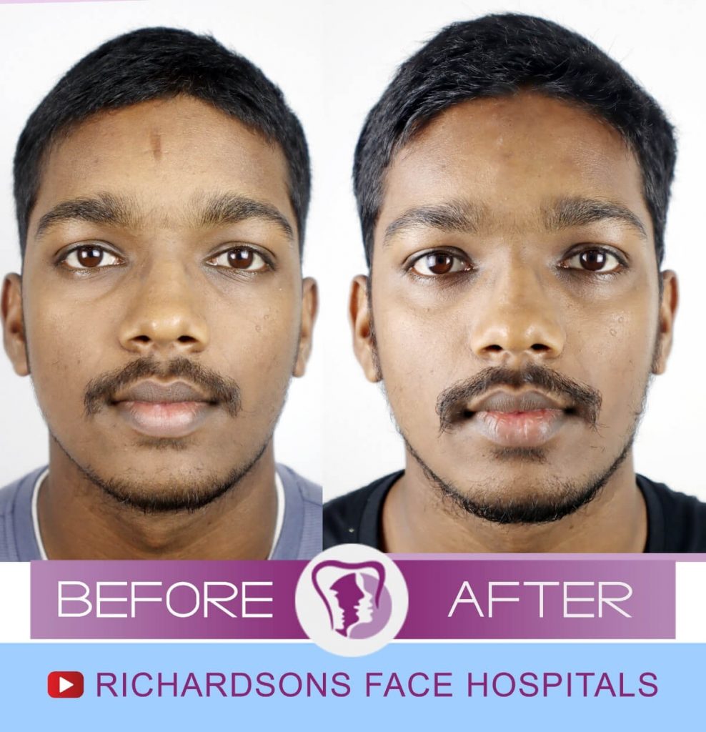 Scar Removal Surgery Photos | Richardsons Hospital