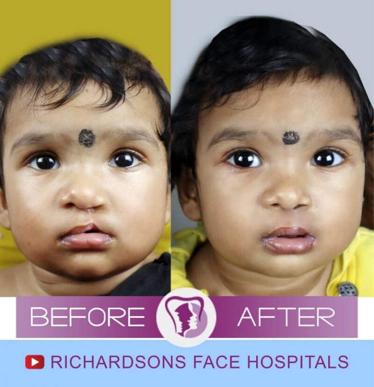 Cleft Lip And Palate Surgery Photos | Richardsons Hospital