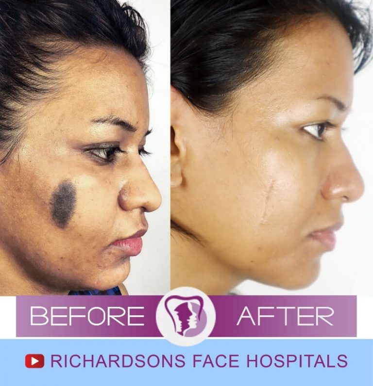 Scar Removal Surgery Photos | Richardsons Hospital