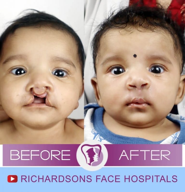 Cleft Lip And Palate Surgery Photos | Richardsons Hospital