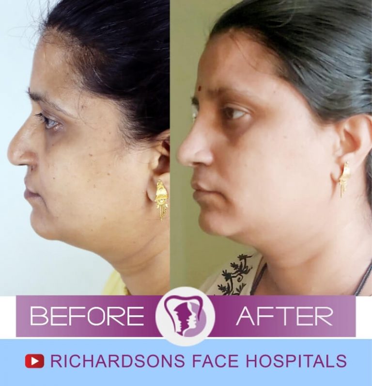 Lip Revision Surgery Photos | Richardsons Hospital