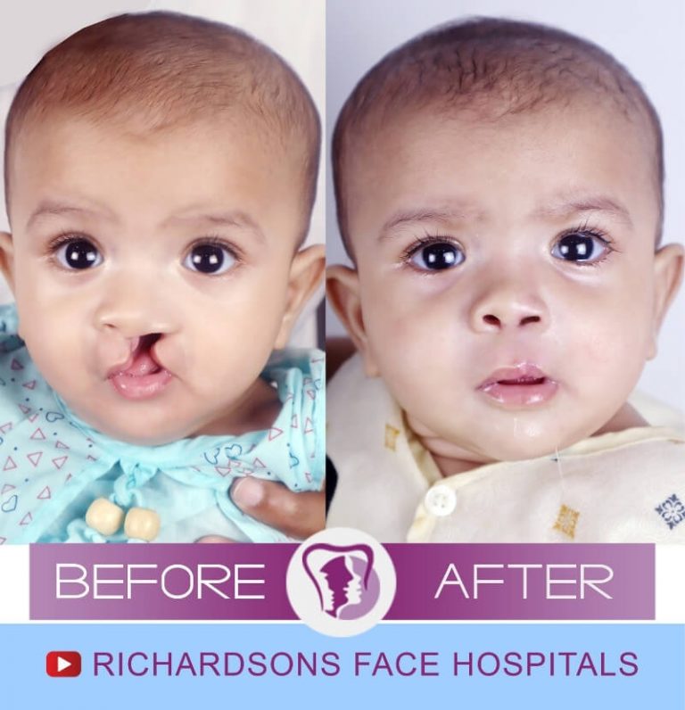 Cleft Lip And Palate Surgery Photos | Richardsons Hospital