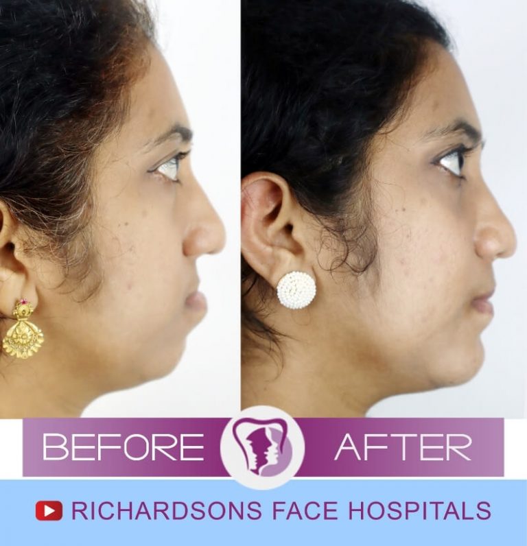 Anterior Maxillary Distraction Photos | Richardsons Hospital