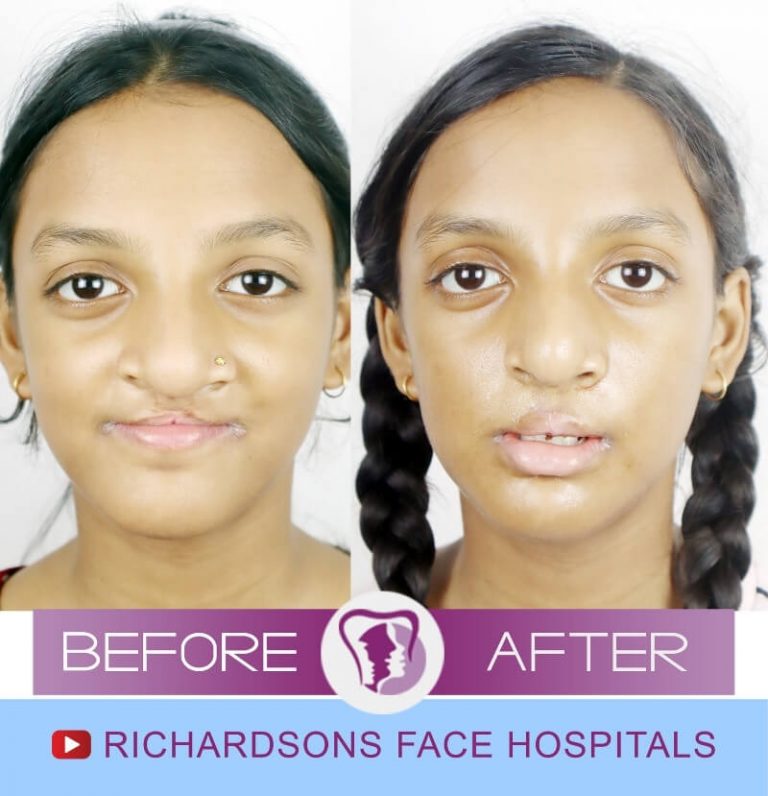 Anterior Maxillary Distraction Photos | Richardsons Hospital