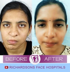 Anterior Maxillary Distraction Photos | Richardsons Hospital