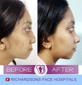 Anterior Maxillary Distraction Photos | Richardsons Hospital