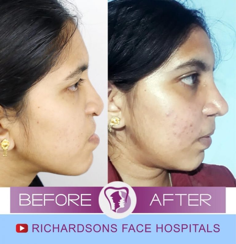 Anterior Maxillary Distraction Photos | Richardsons Hospital