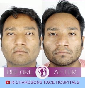 Lip Revision Surgery Photos | Richardsons Hospital