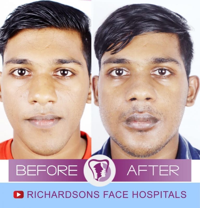 Everything You Need to Know About Orthognathic Surgery to Correct ...