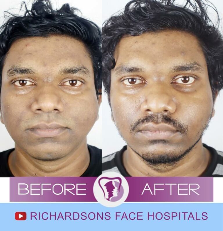 Facial Asymmetry Surgery Photos | Richardsons Hospital