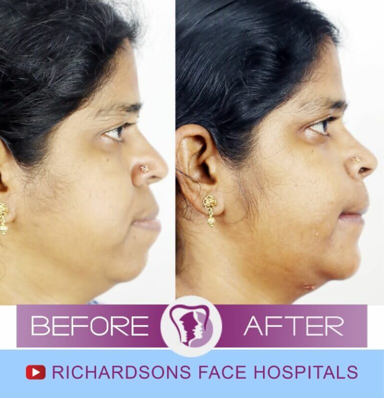 Anterior Maxillary Distraction Photos | Richardsons Hospital