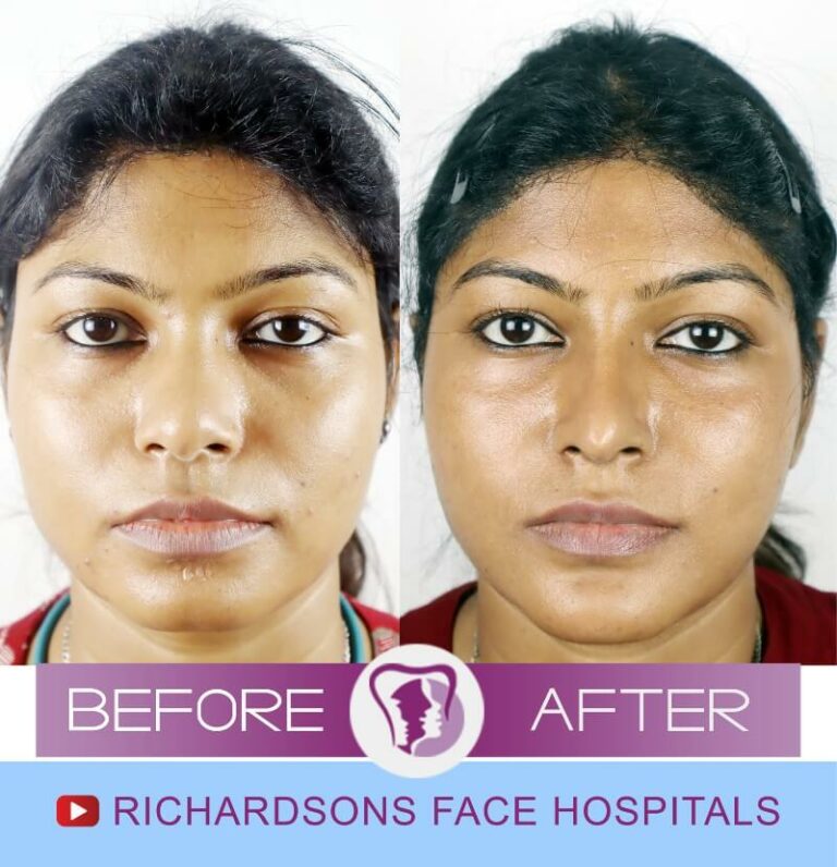 Face Makeover Surgery Photos | Richardsons Hospital