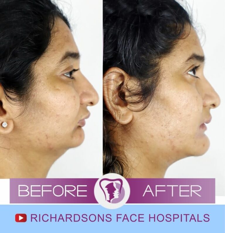 Everything You Must Know About Correcting Underbite With Lower Jaw ...