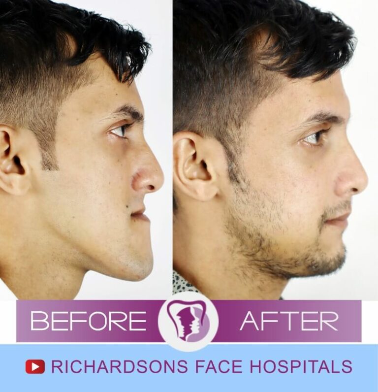 All That You Must Know About Underbite Upper Jaw Surgery – Richardson's ...
