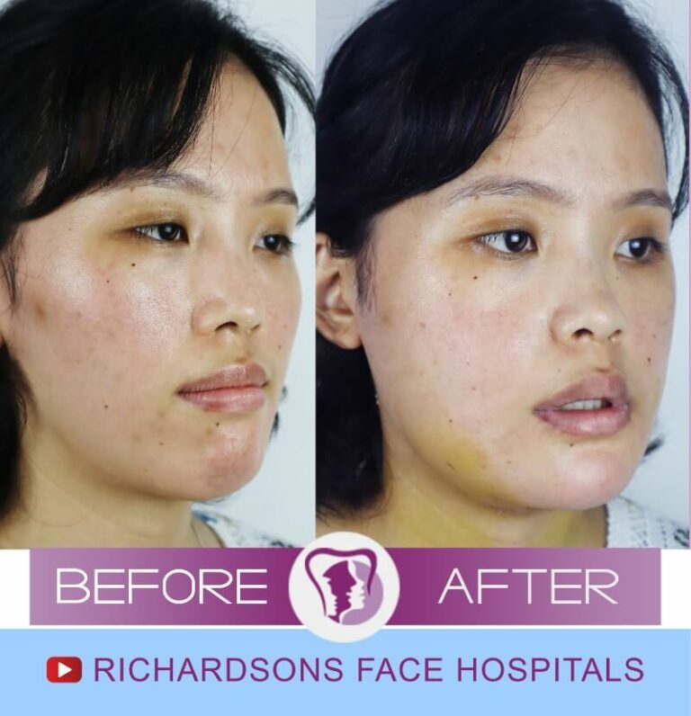 2 Things You Must Know About Underbite Jaw Surgery In India ...