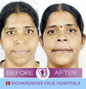 Anterior Maxillary Distraction Photos | Richardsons Hospital