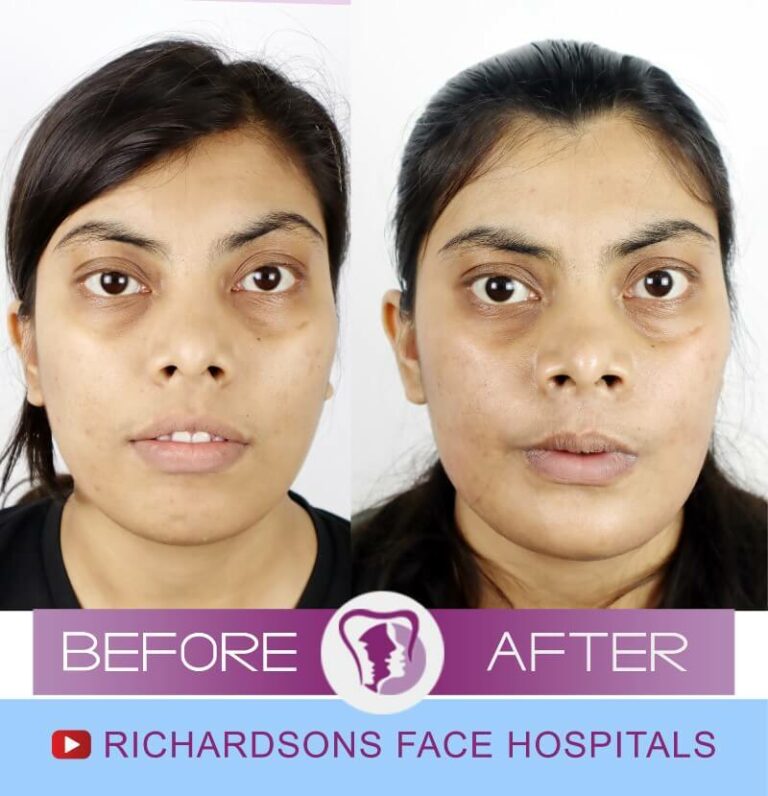 Facial Asymmetry Surgery Photos | Richardsons Hospital