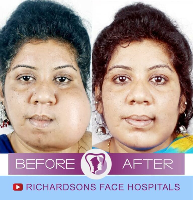 Everything You Must Know About Face Tumor Removal Surgery
