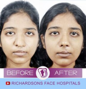 Lip Revision Surgery Photos | Richardsons Hospital