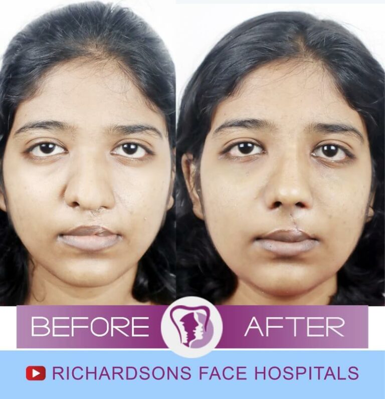 Lip Revision Surgery Photos | Richardsons Hospital