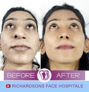 Lip Revision Surgery Photos | Richardsons Hospital