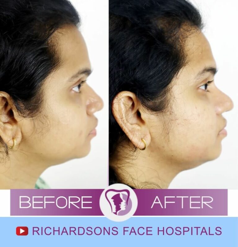 Nose Surgery Photos | Richardsons Hospital