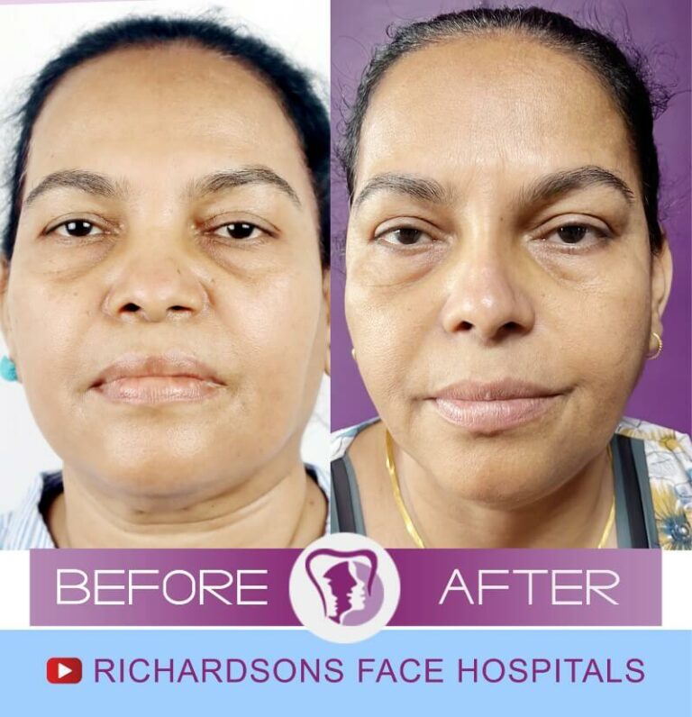 Nose Surgery Photos | Richardsons Hospital