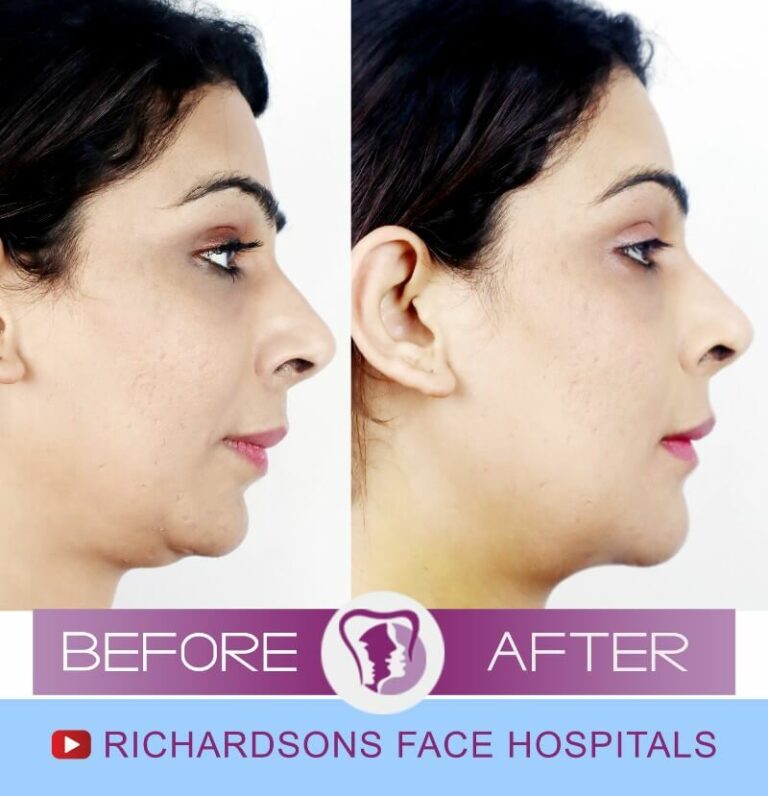 Face Makeover Surgery Photos | Richardsons Hospital