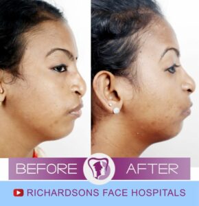 Lip Revision Surgery Photos | Richardsons Hospital
