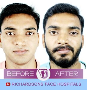 Lip Revision Surgery Photos | Richardsons Hospital