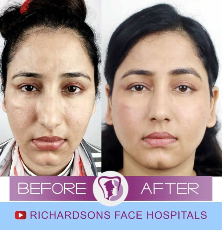 Lip Revision Surgery Photos | Richardsons Hospital