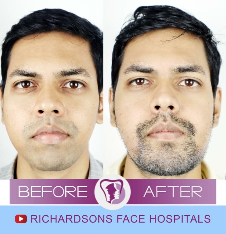 Facial Asymmetry Surgery Photos | Richardsons Hospital