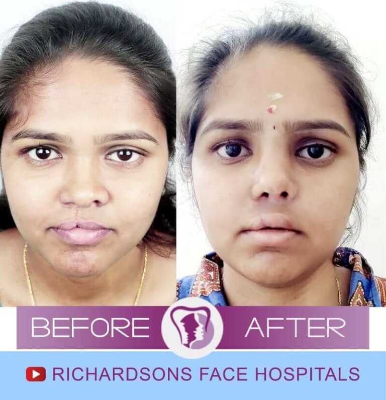 Lip Revision Surgery Photos | Richardsons Hospital