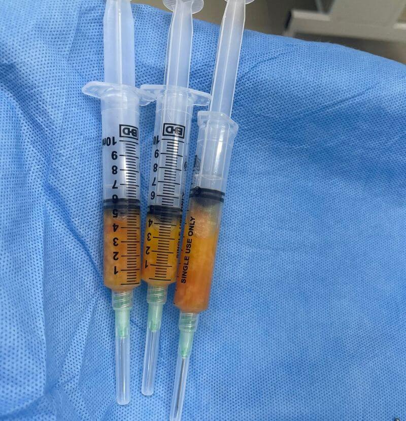 Facial Fat Grafting Scar Revision India: A Safe And Effective Treatment ...