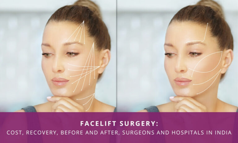 Facelift Surgery Cost, Recovery, Before and After, Surgeons and ...