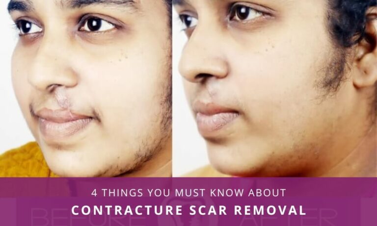 Four Things You Must Know About Contracture Scar Removal – Richardson's ...