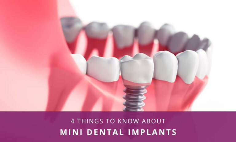 Four Things To Know About Mini Dental Implants – Richardson's Plastic ...