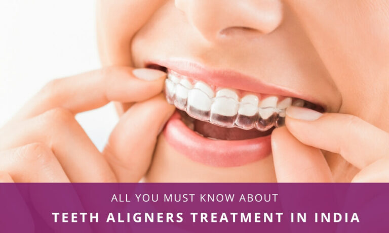 All You Must Know About Teeth Aligners Treatment In India – Richardson ...