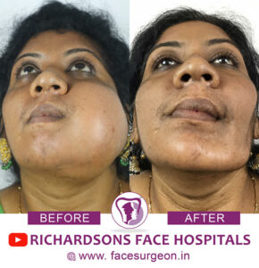 Everything You Must Know About Face Tumor Surgery – Richardson's Plastic Surgery Hospitals