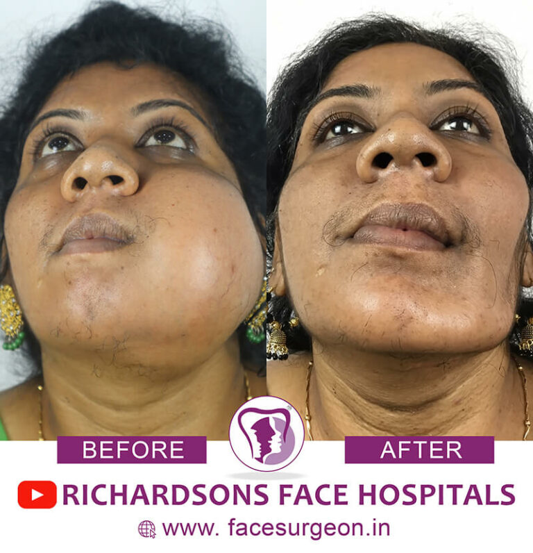 Everything You Must Know About Face Tumor Surgery – Richardson's ...