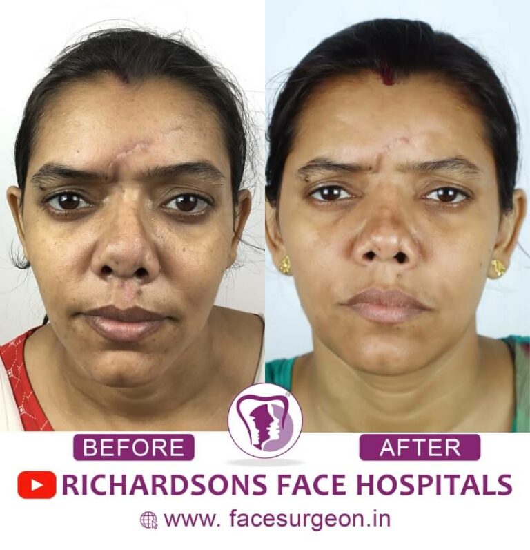 Facial Trauma Surgery Photos | Richardsons Hospital