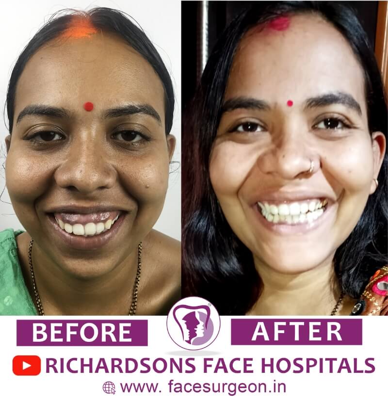 Five Things You Must Know About Gum Contouring Treatment – Richardson's ...