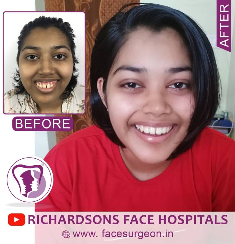 Four Things You Need To Know About Gum Depigmentation Treatment ...