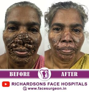 Types of Facial Tumors in Adults | Causes, Symptoms, Treatment Cost – Richardson's Plastic ...