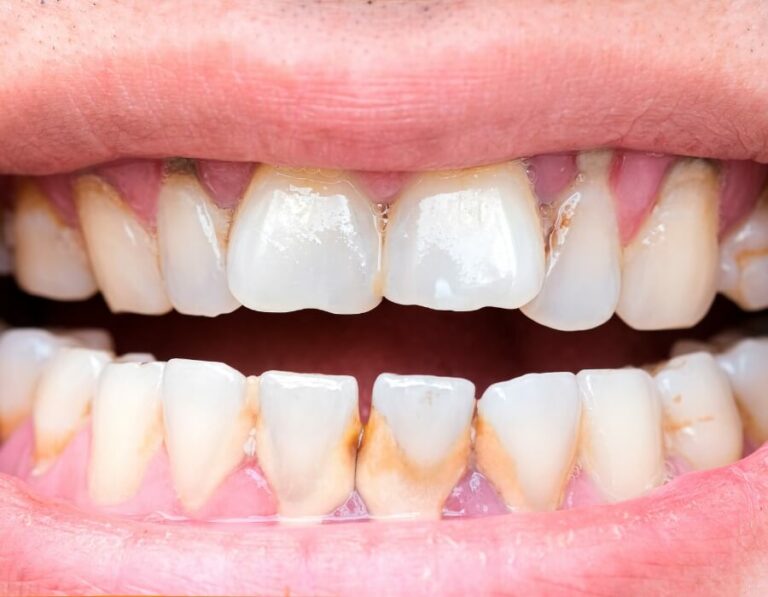 Everything You Need to Know About Enamel Erosion Treatment – Richardson ...