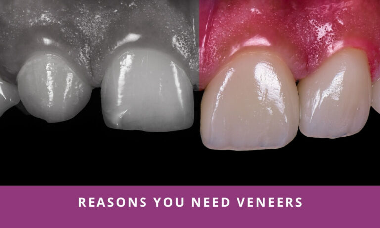 Four Reasons You Need Veneers – Richardson's Plastic Surgery Hospitals