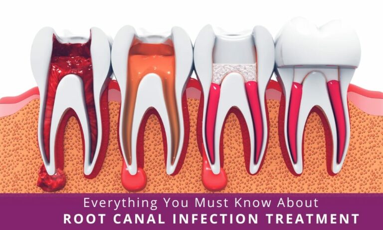Everything You Must Know About Root Canal Infection Treatment ...