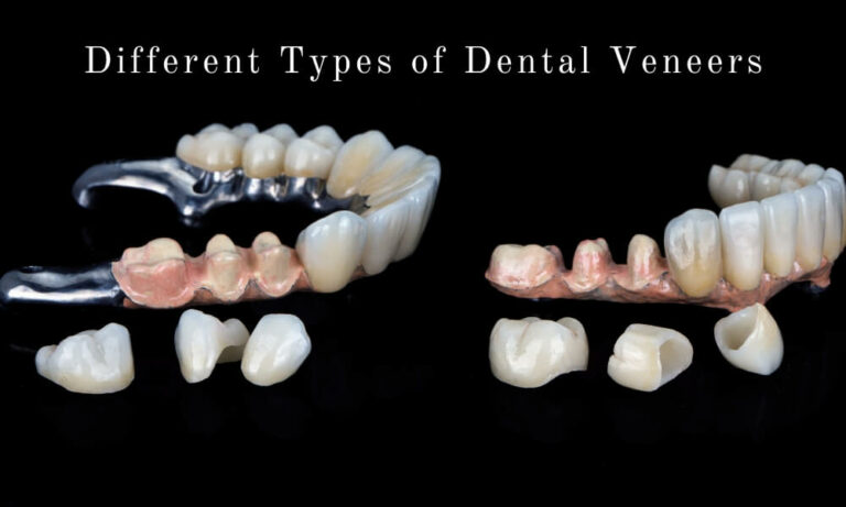 Five Different Types Of Dental Veneers – Richardson's Plastic Surgery Hospitals