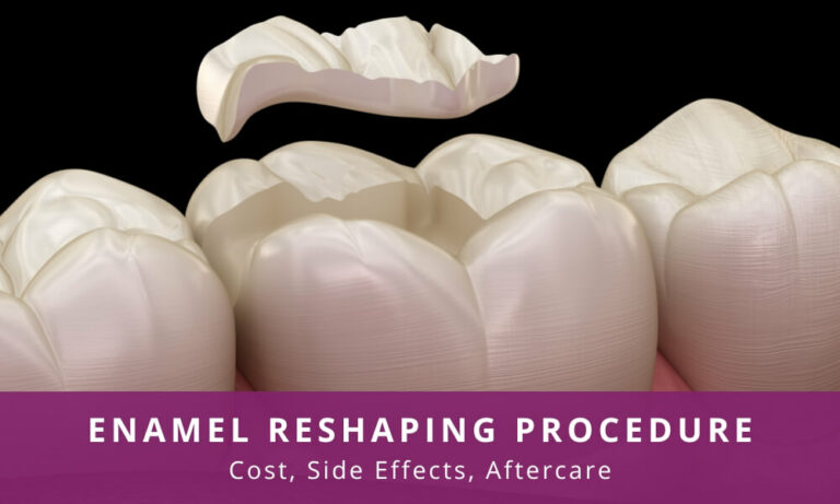 Enamel Reshaping Procedure: Cost, Side Effects, Aftercare – Richardson ...